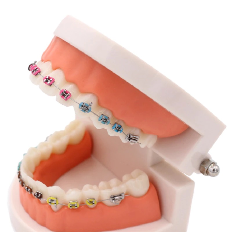 Arcada dental brackets modelo de tratamiento de ortodoncia dental