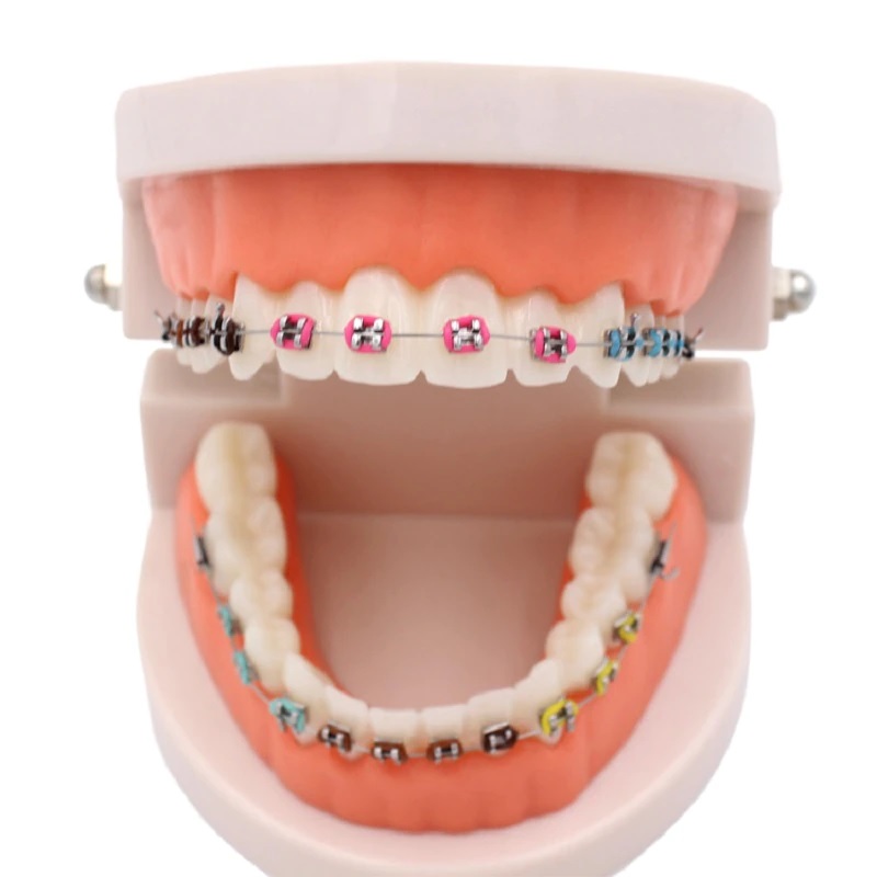 Arcada dental brackets modelo de tratamiento de ortodoncia dental